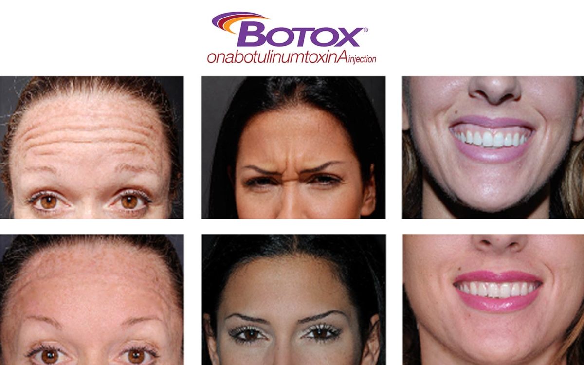 Botox® - Johnson Family Dentistry | Dentist in Devil's Lake ND