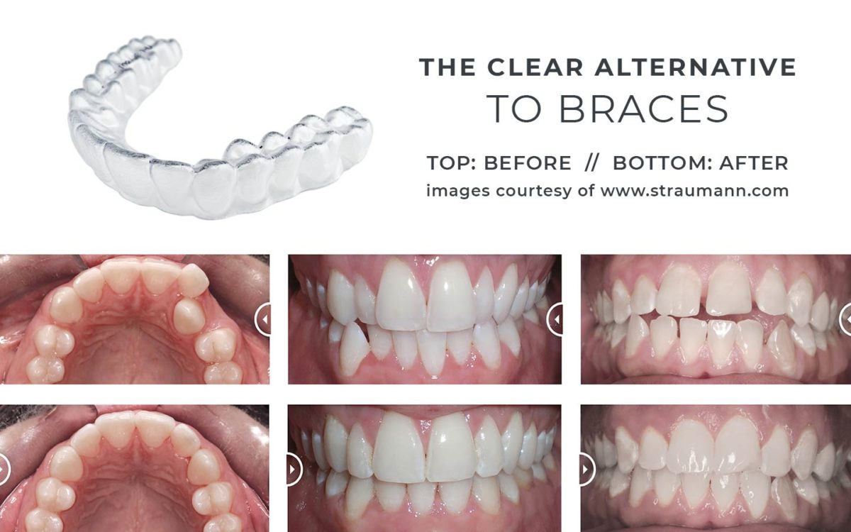 Clear Aligner Therapy - Johnson Family Dentistry | Dentist in Devil's ...